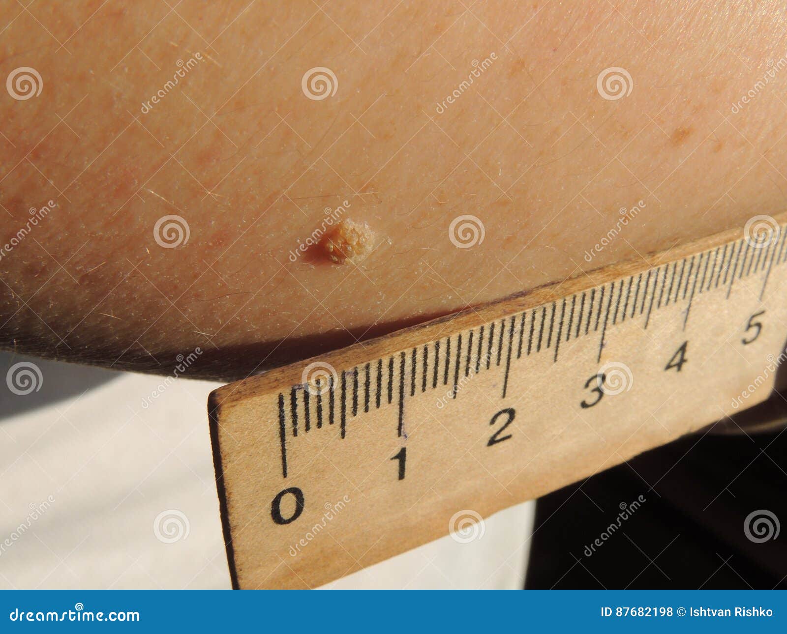 Muttermal auf der Haut stockfoto. Bild von gealtert, behandlung - 87682198