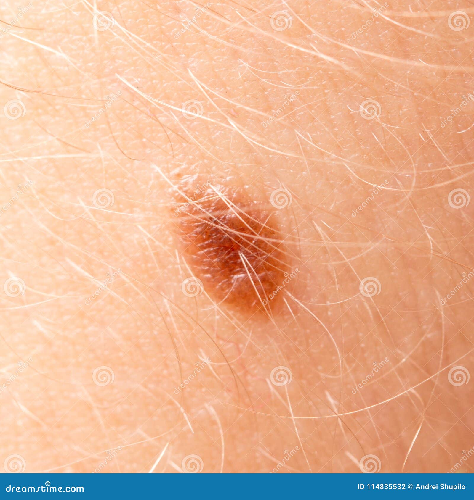 Muttermal Auf Der Haut Als Hintergrund Stockfoto - Bild von hintergrund ...