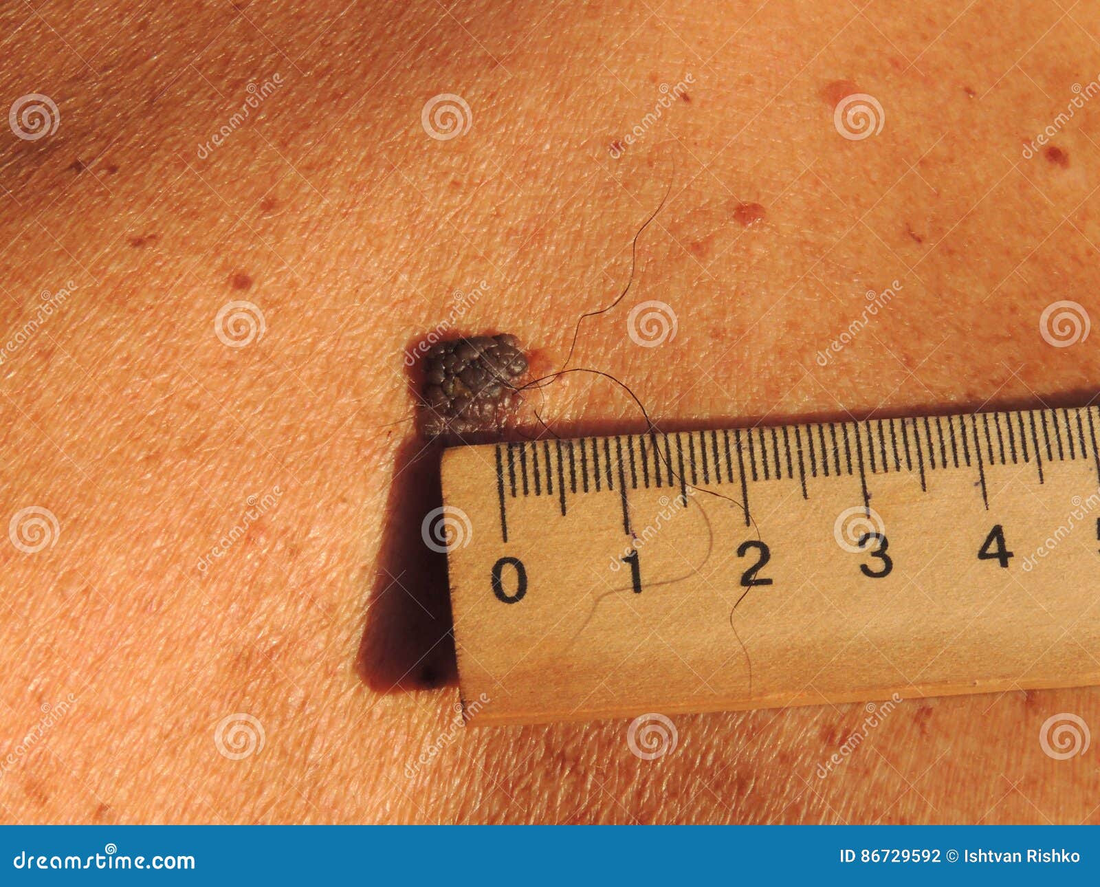 Muttermal Auf Der Haut Der Mitte Alterte Mann Stockfoto - Bild von ...