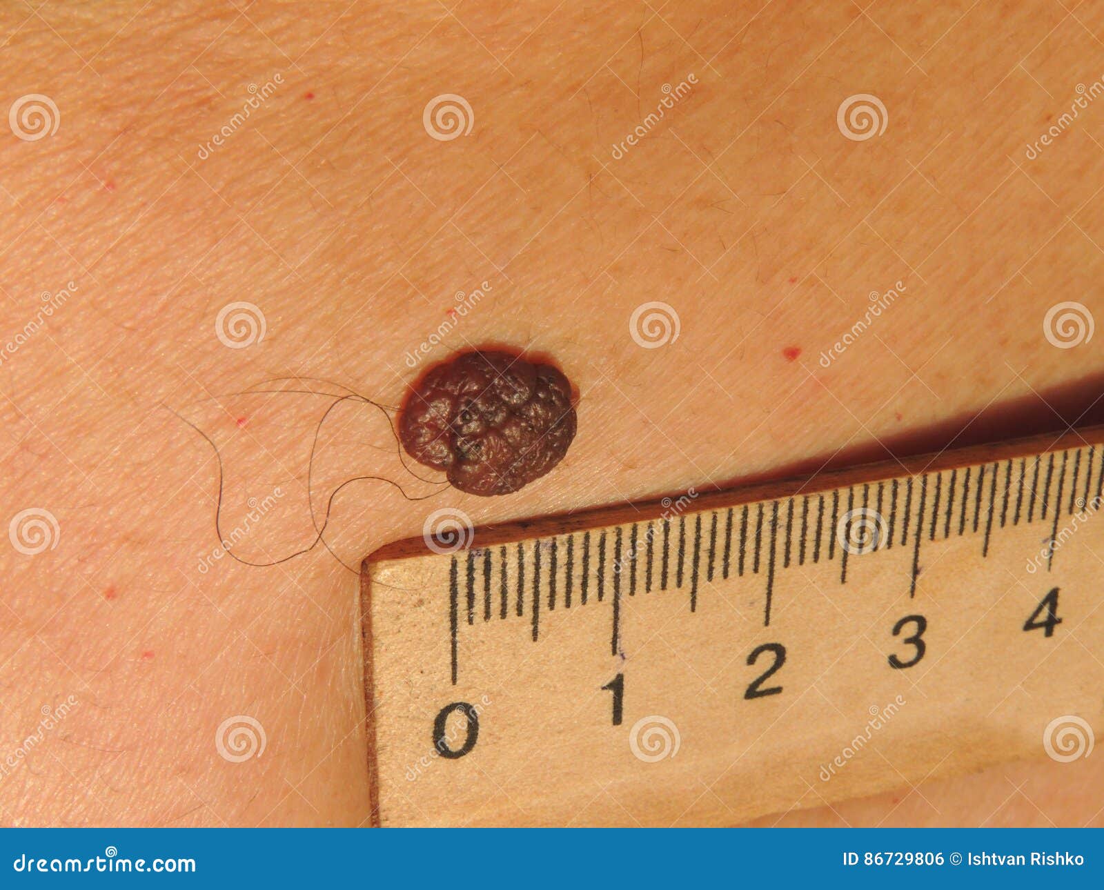 Muttermal Auf Der Haut Der Mitte Alterte Mann Stockfoto - Bild von ...