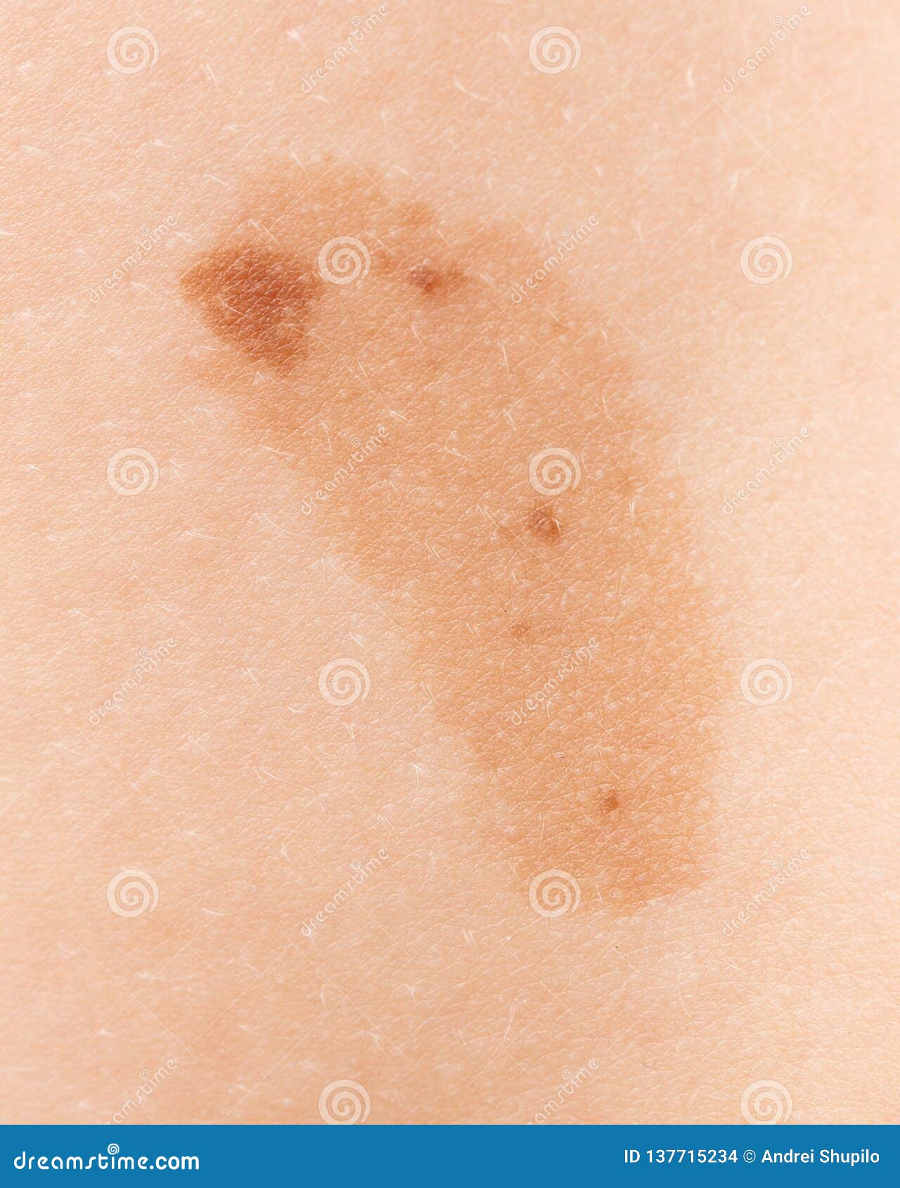Muttermal Auf Der Haut Einer Person Stockfoto - Bild von tumor ...
