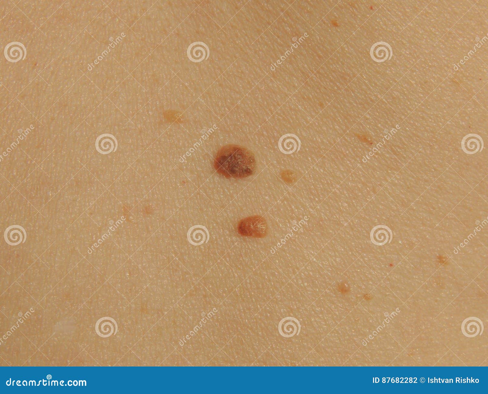 Muttermale auf der Haut stockfoto. Bild von medizin, überprüfung - 87682282