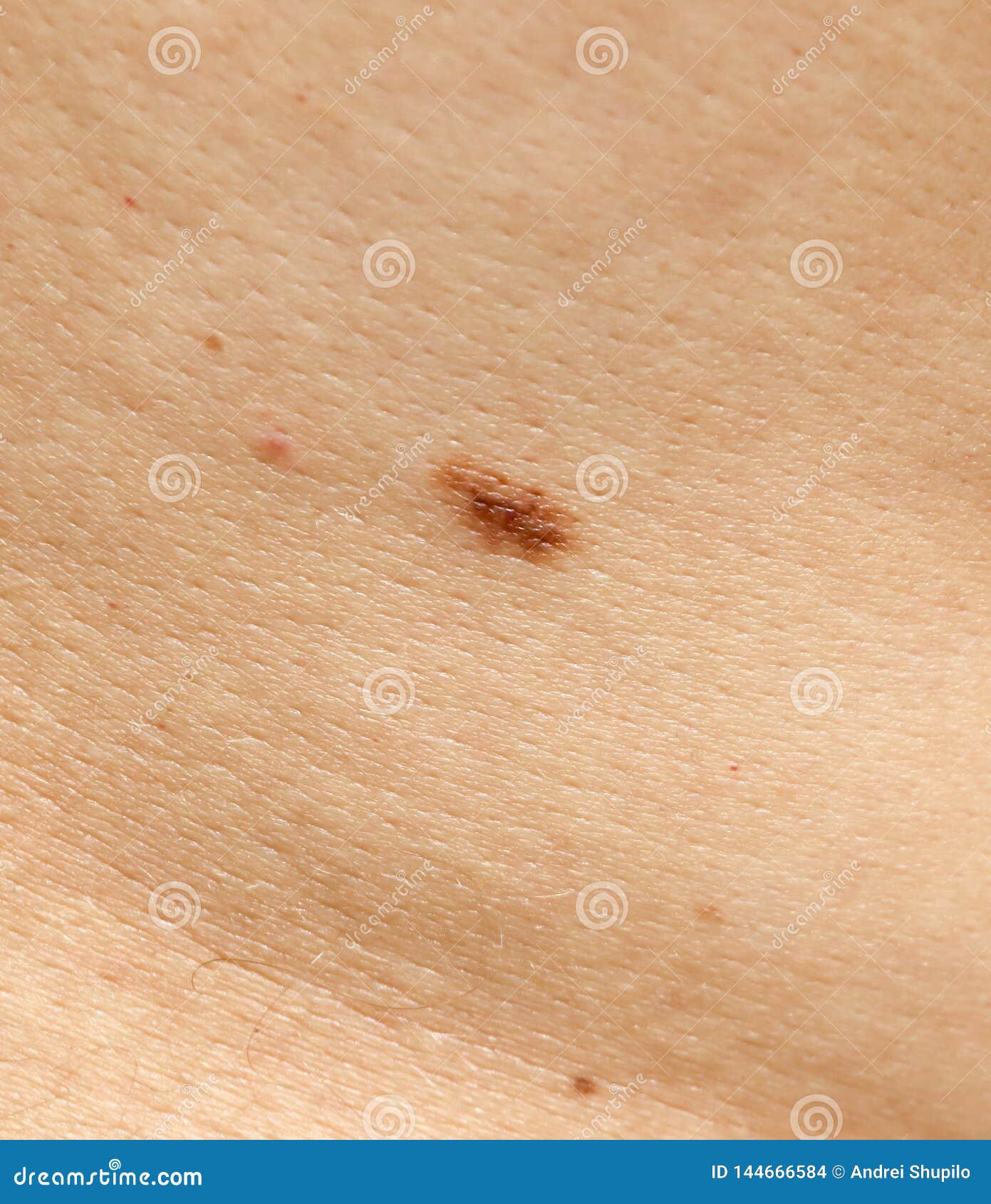 Muttermale Auf Der Haut Als Hintergrund Stockfoto - Bild von haut ...