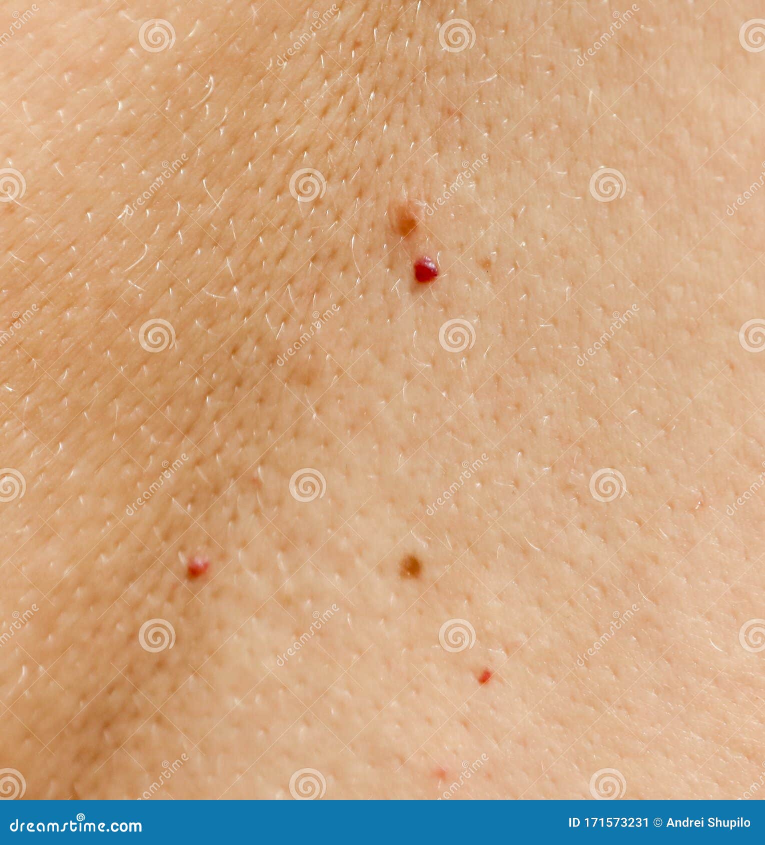 Muttermale Auf Der Haut Als Hintergrund Stockbild - Bild von ...