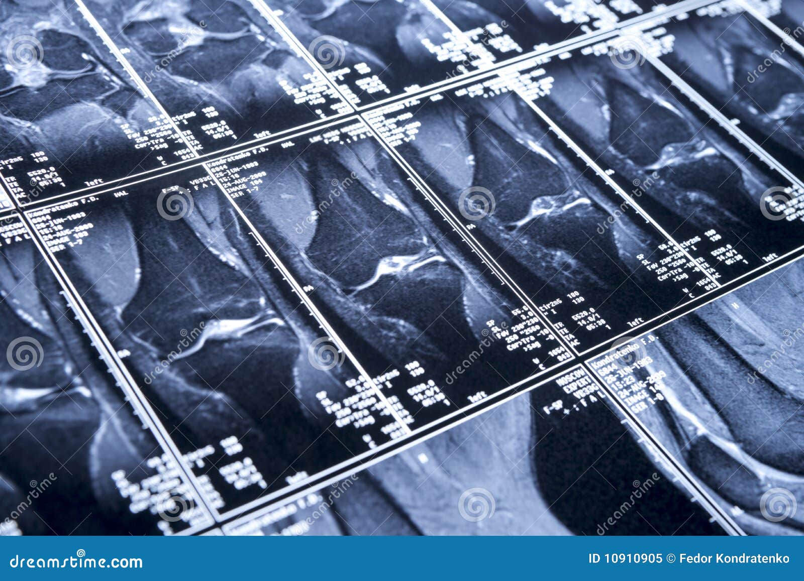 My Knee MRI - Damage of Cross-shaped Ligaments Stock Image - Image of ...