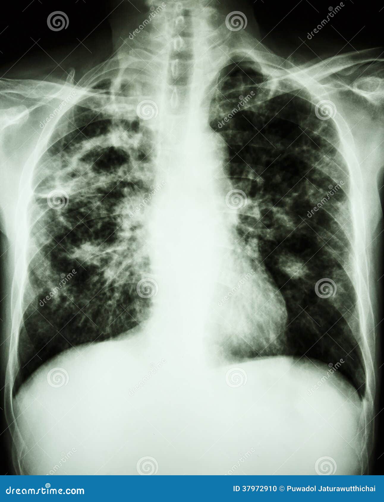 Mycobacterium Tuberculosis Infection (Pulmonary Tuberculosis) Stock ...