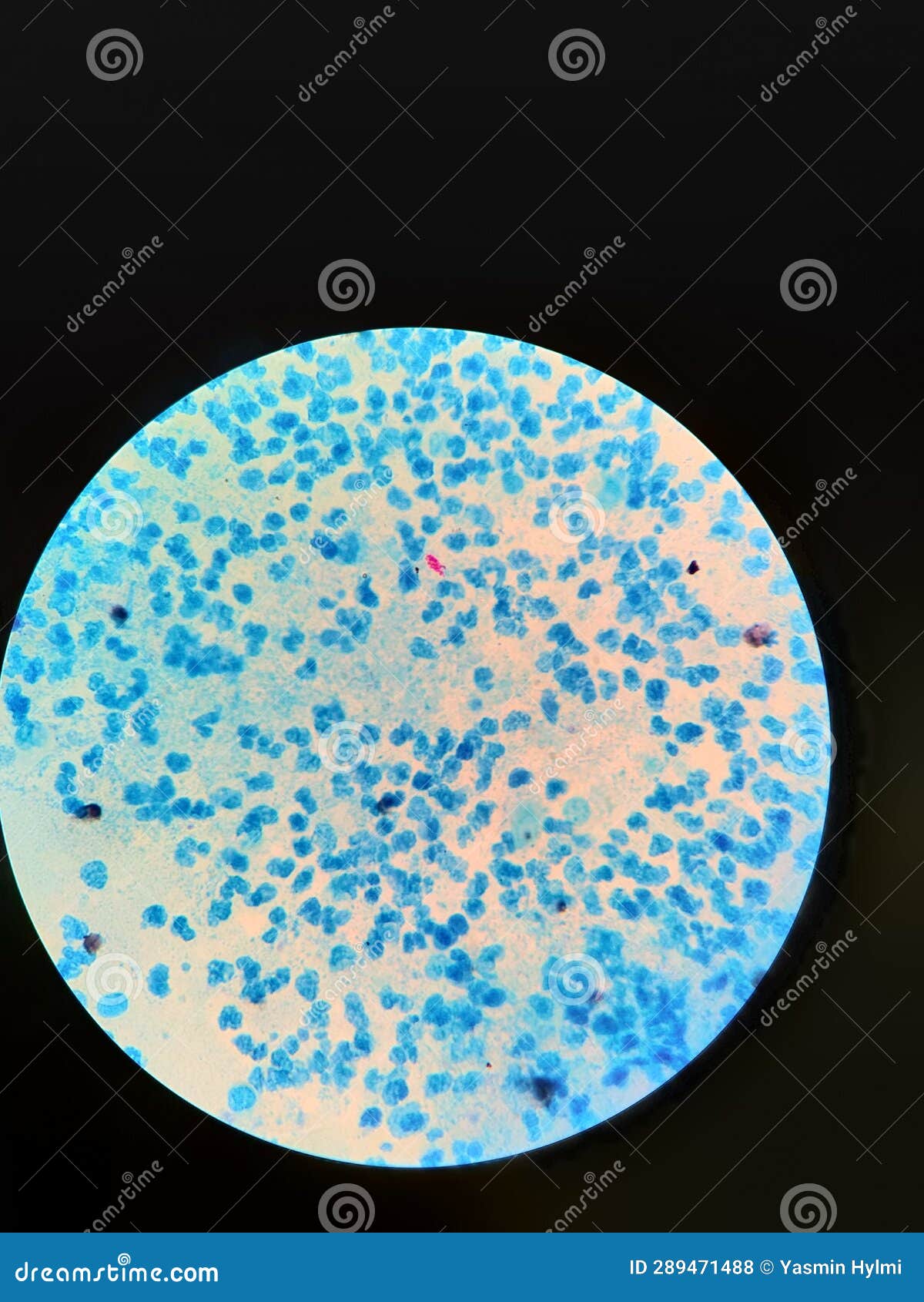 Mycobacterium Tuberculosis Positive in Sputum (tuberculosis) Stock ...