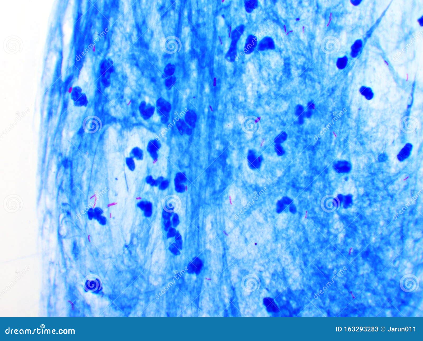 Mycobacterium Tuberculosis Positive In Sputum Smear Stock Image ...