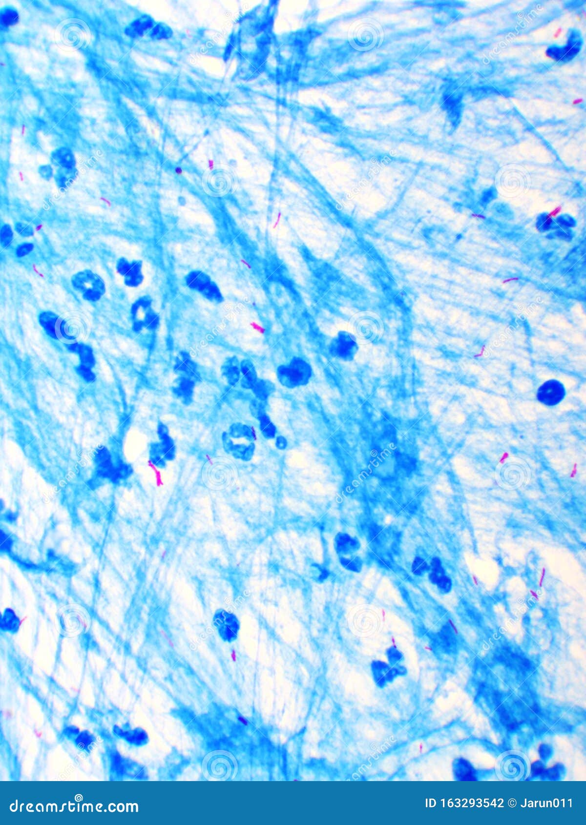 Mycobacterium Tuberculosis Positive in Sputum Smear Stock Photo - Image ...