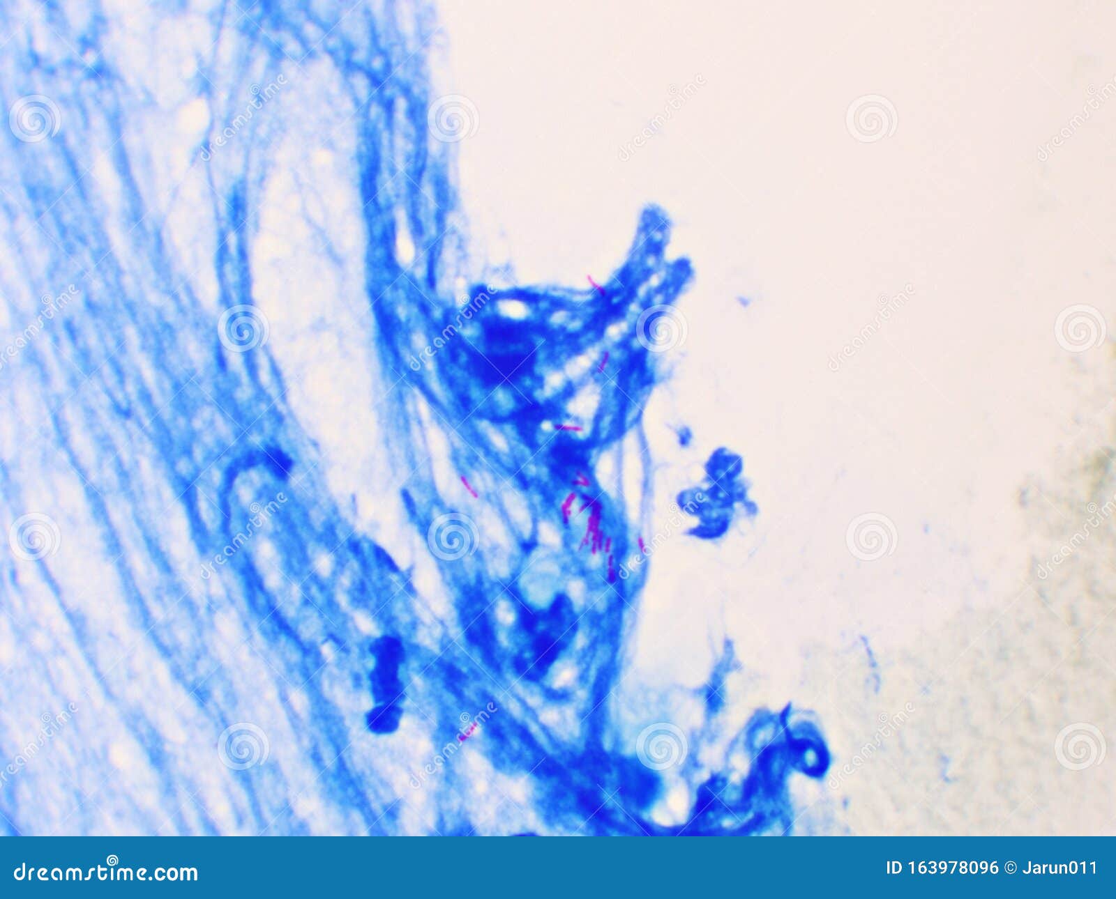 Mycobacterium Tuberculosis Positive in Sputum Smear Stock Photo - Image ...