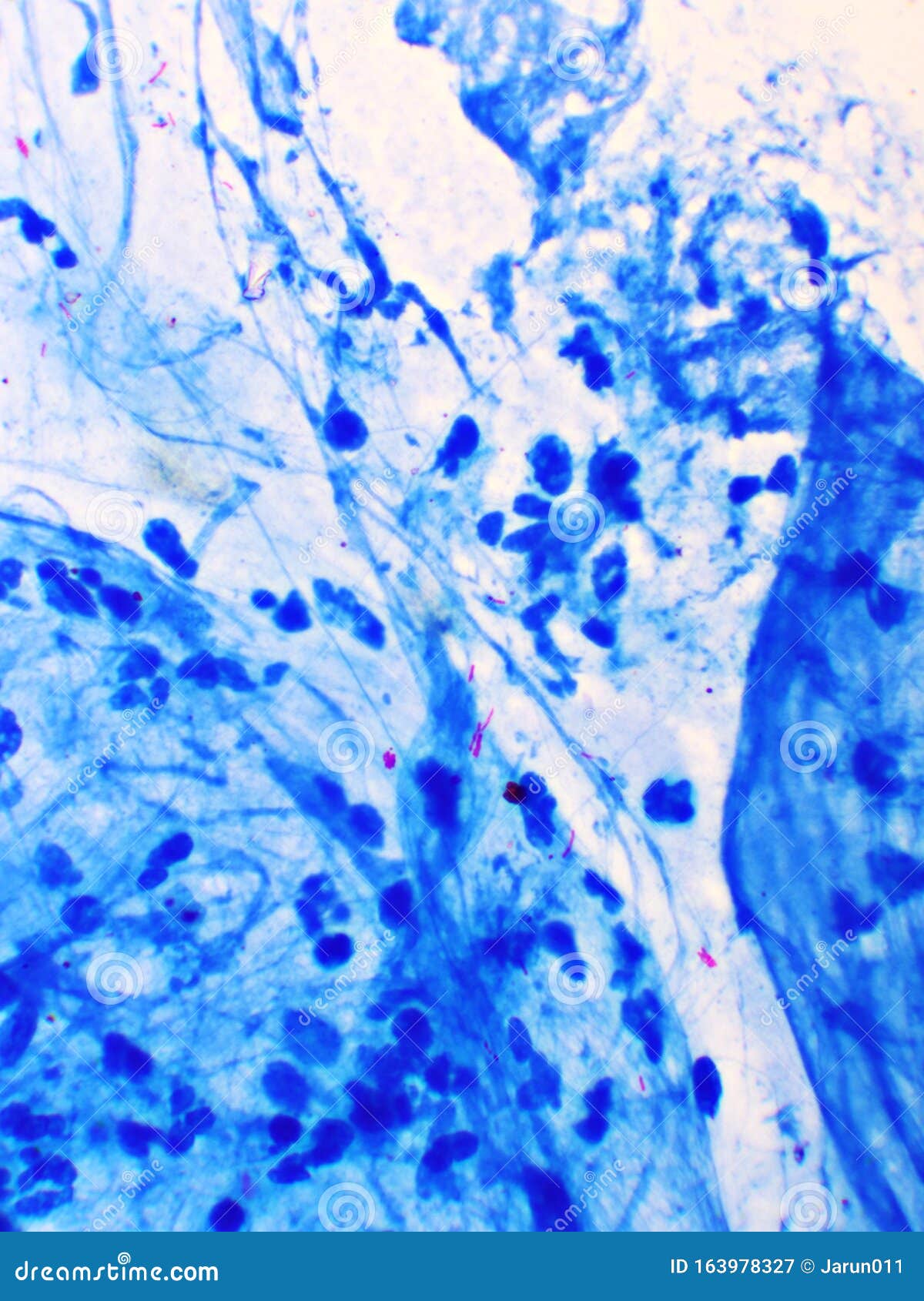 Mycobacterium Tuberculosis Positive in Sputum Smear Stock Image - Image ...