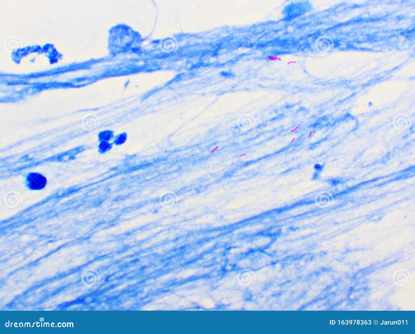 Mycobacterium Tuberculosis Positive in Sputum Smear Stock Image - Image ...