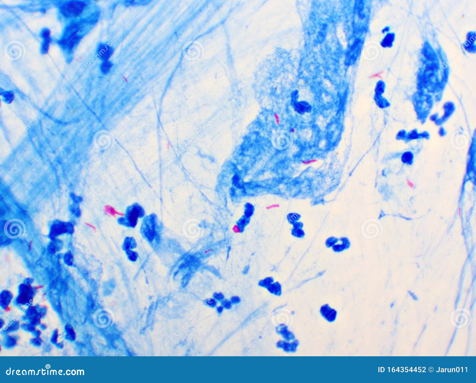 Mycobacterium Tuberculosis Positive in Sputum Smear Stock Photo - Image ...