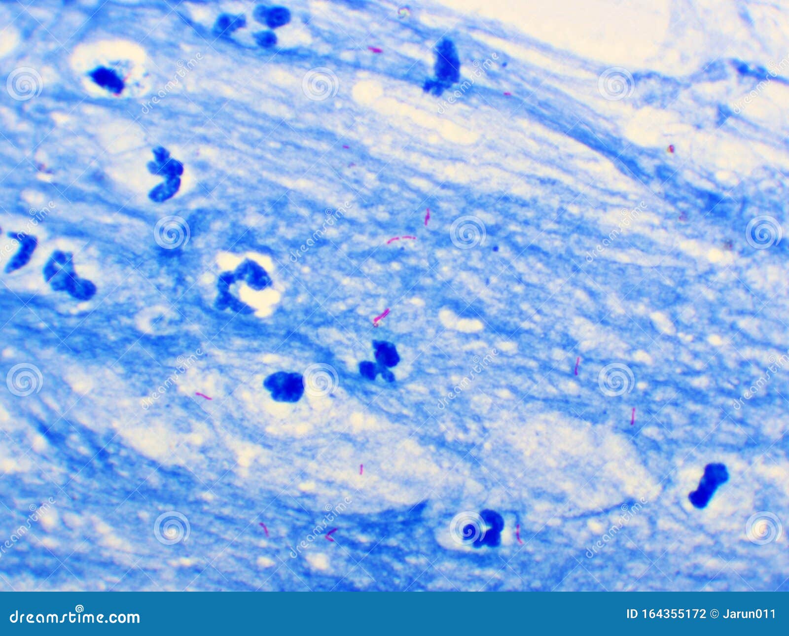 Mycobacterium Tuberculosis Positive in Sputum Smear Stock Photo - Image ...