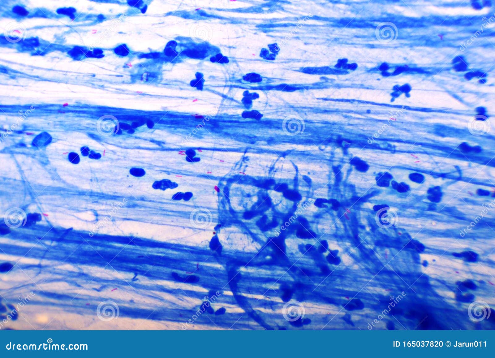 Mycobacterium Tuberculosis Positive in Sputum Smear Stock Photo - Image ...
