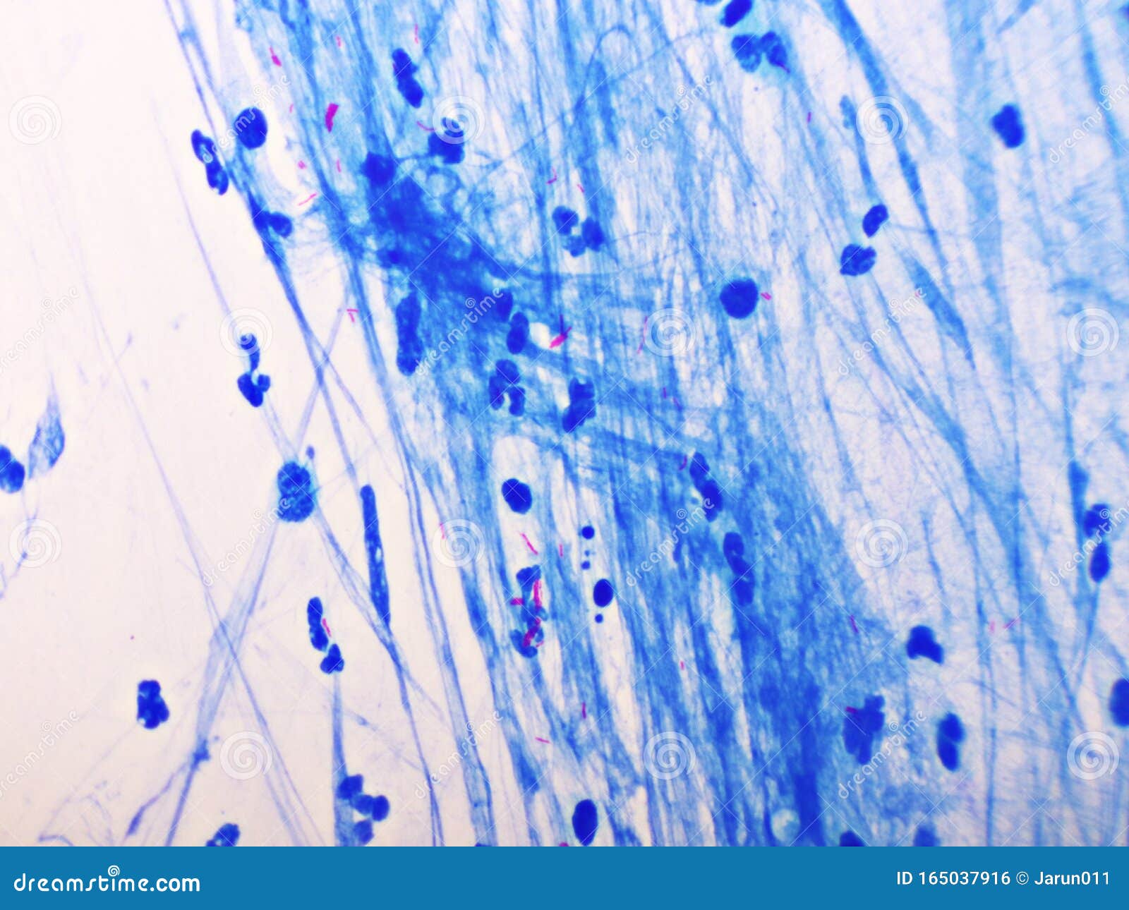 Mycobacterium Tuberculosis Positive in Sputum Smear Stock Photo - Image ...