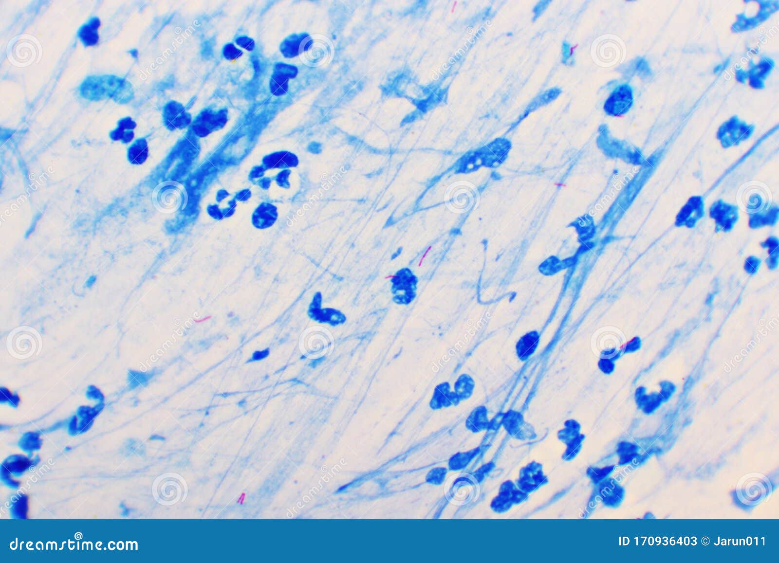 Mycobacterium Tuberculosis Positive in Sputum Smear Stock Image - Image ...