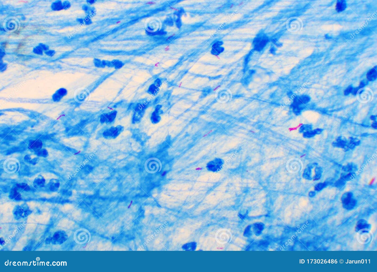 Mycobacterium Tuberculosis Positive in Sputum Smear Stock Photo - Image ...