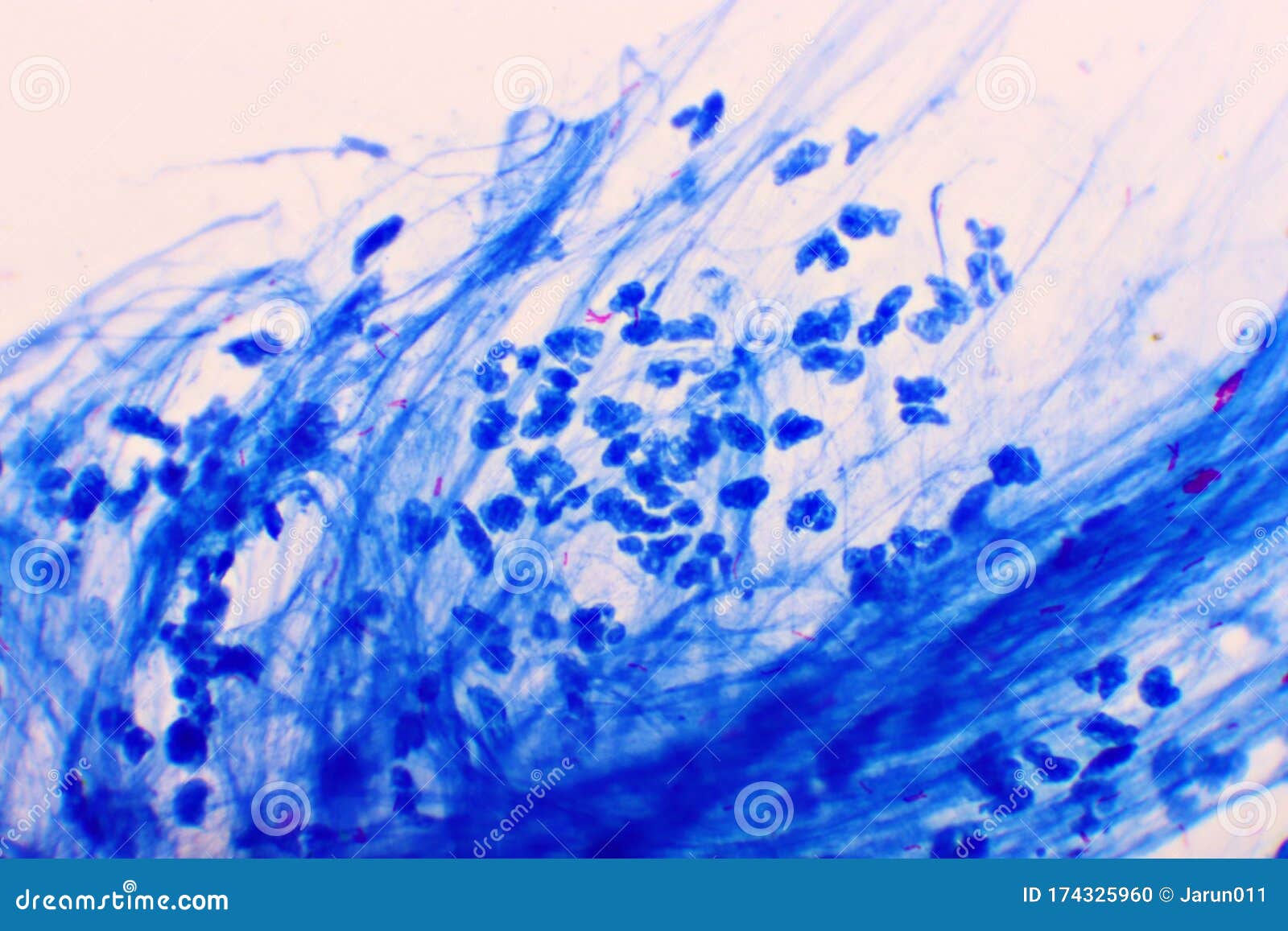 Mycobacterium Tuberculosis Positive in Sputum Smear Stock Photo - Image ...