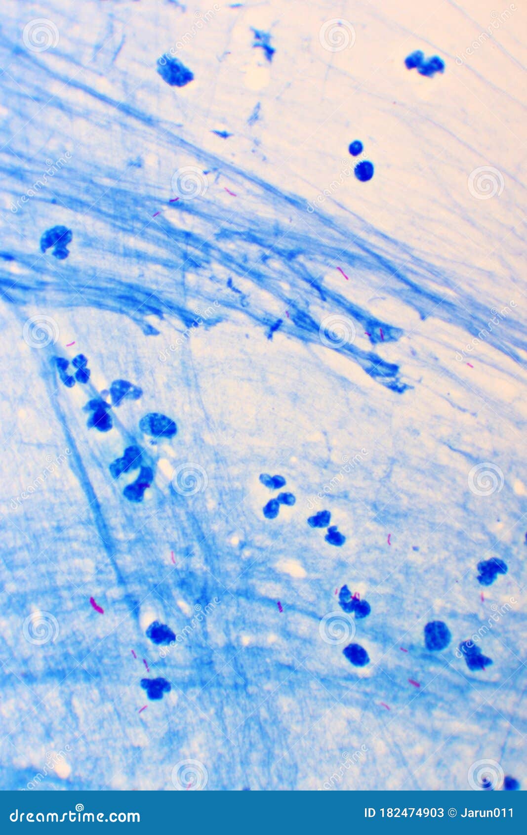 Mycobacterium Tuberculosis Positive in Sputum Smear Stock Image - Image ...