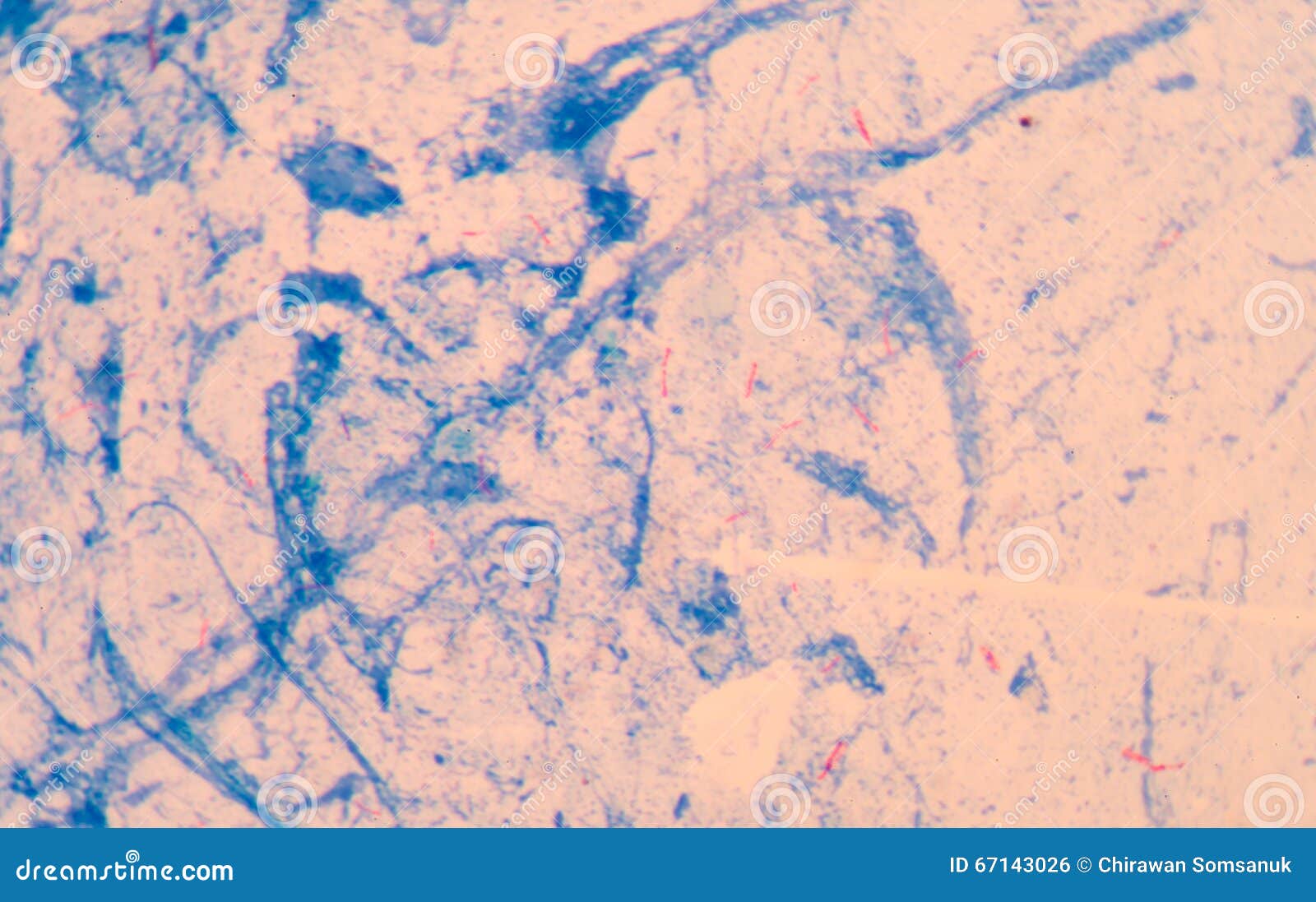 Mycobacterium Tuberculosis Red Cells. Stock Photo - Image of body ...