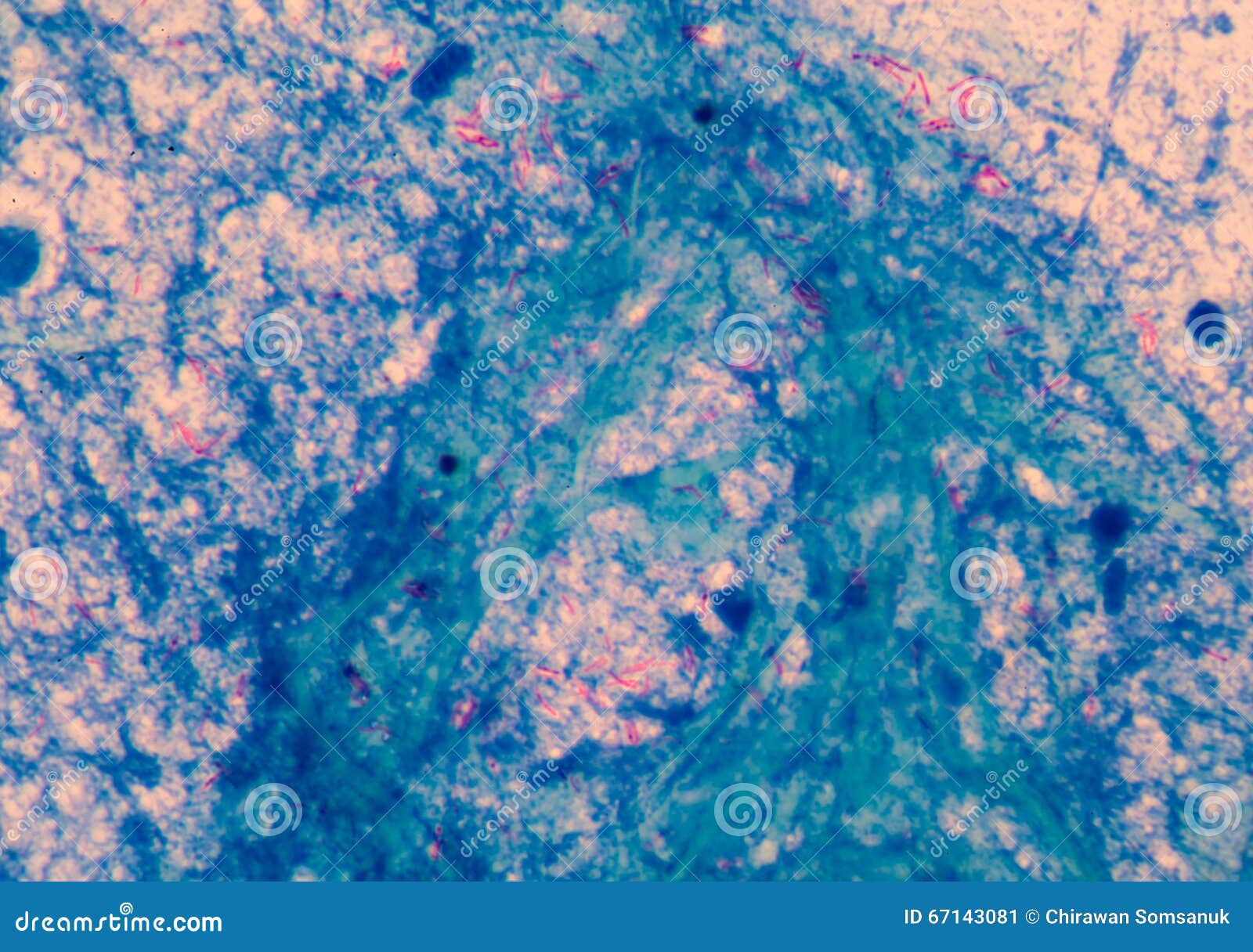 Mycobacterium Tuberculosis Red Cells. Stock Image - Image of healthy ...