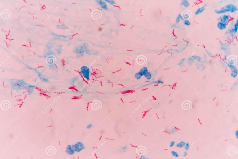 Mycobacterium tuberculosis stock image. Image of microbiology - 80362283