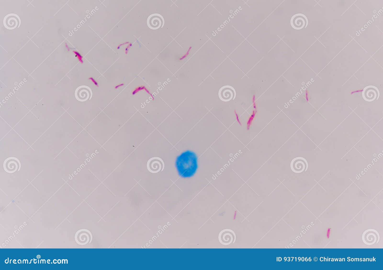 Mycrobacterium Tuberculosis Red Cells. Stock Photo - Image of negative ...