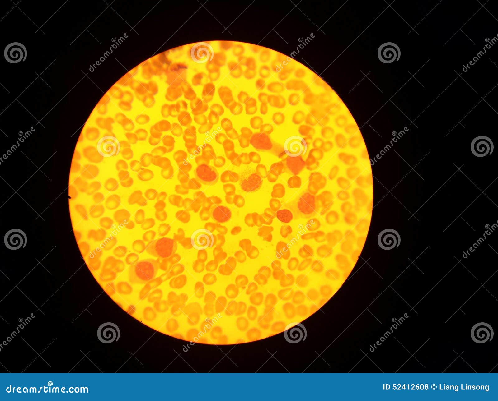 Myeloblasts stock photo. Image of healthcare, morphology - 52412608