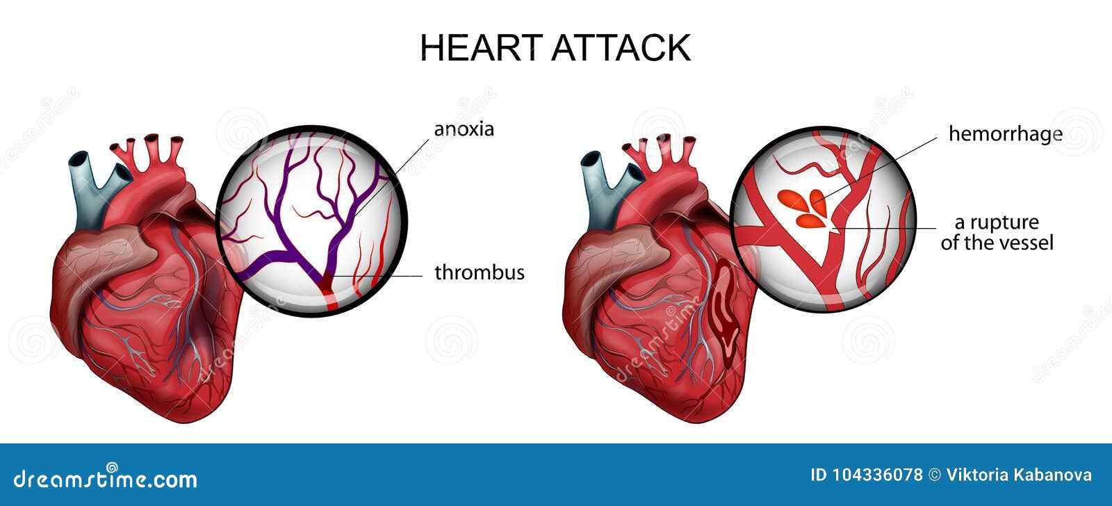 Myocardial Infarction. Thrombosis and Hemorrhage Stock Vector ...