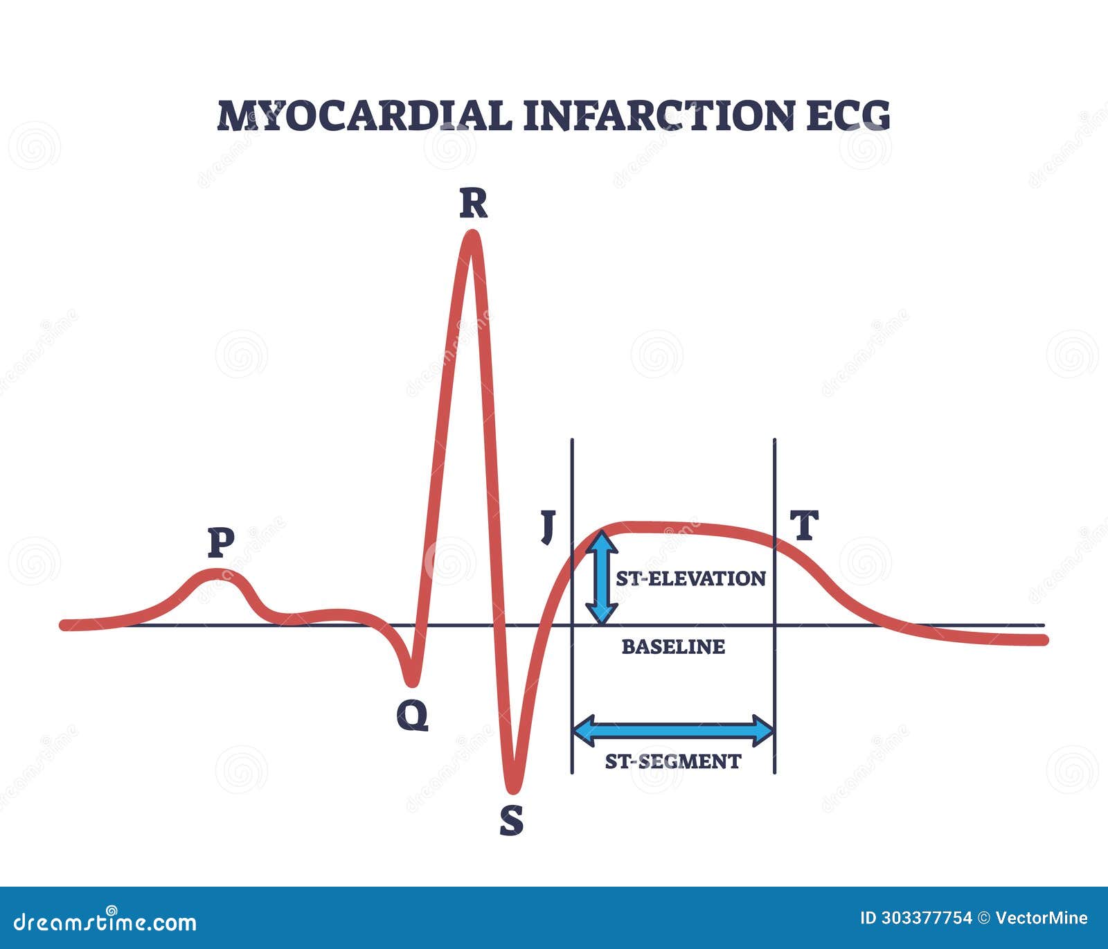 Myocardial Infraction Ecg With Abnormal St Segment Elevation Outline