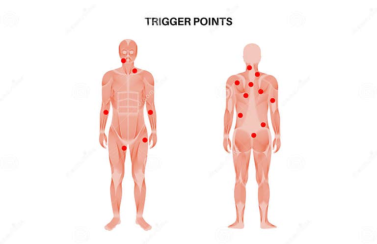 Myofascial Trigger Points Stock Vector Illustration Of Stress 309901947