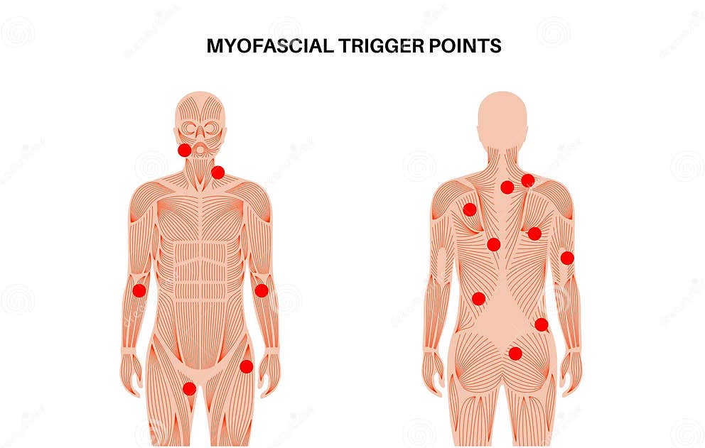Myofascial Trigger Points Stock Vector Illustration Of Fibers 309901926