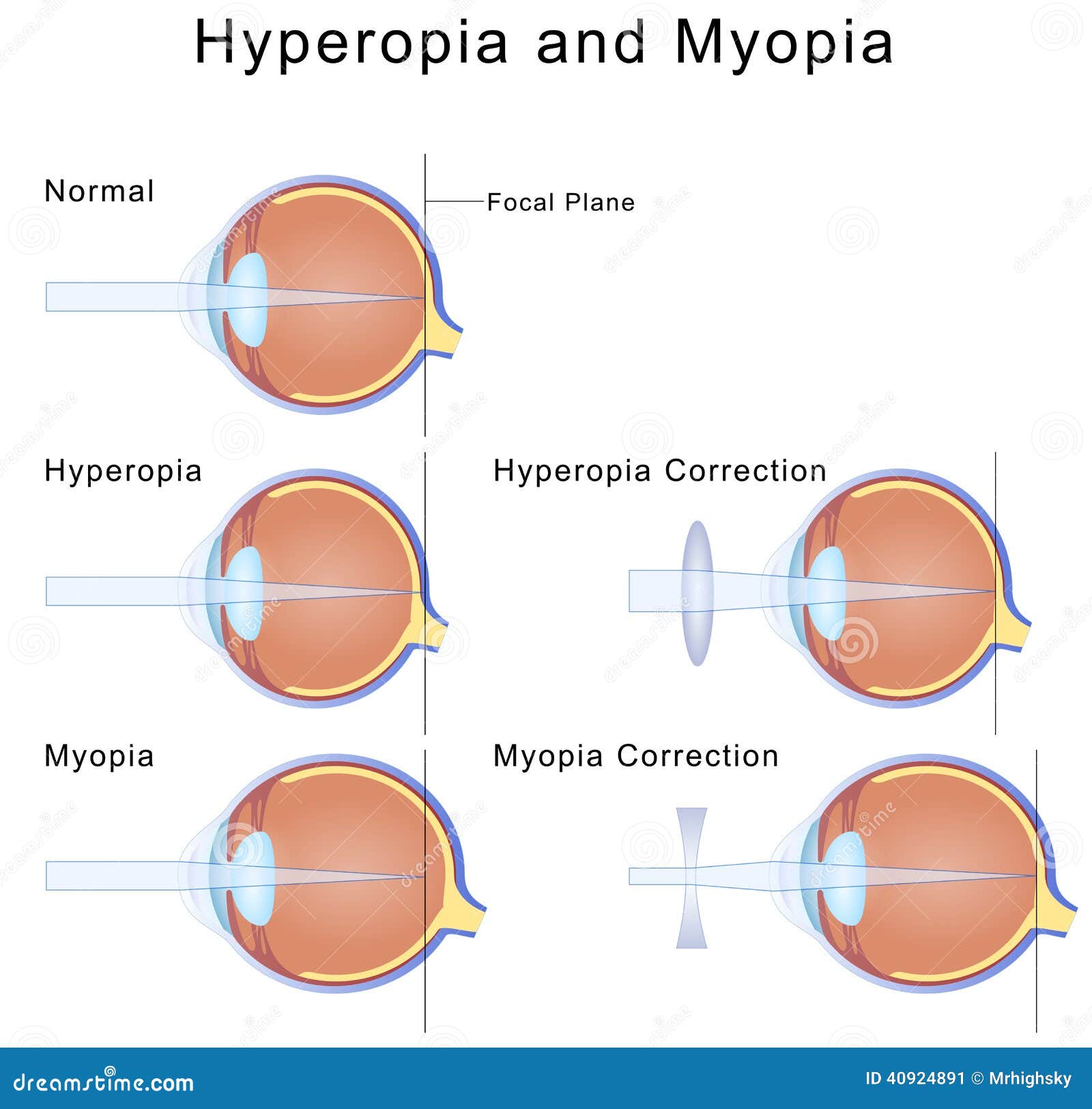 Myopi och Hyperopia vektor illustrationer. Illustration av ...