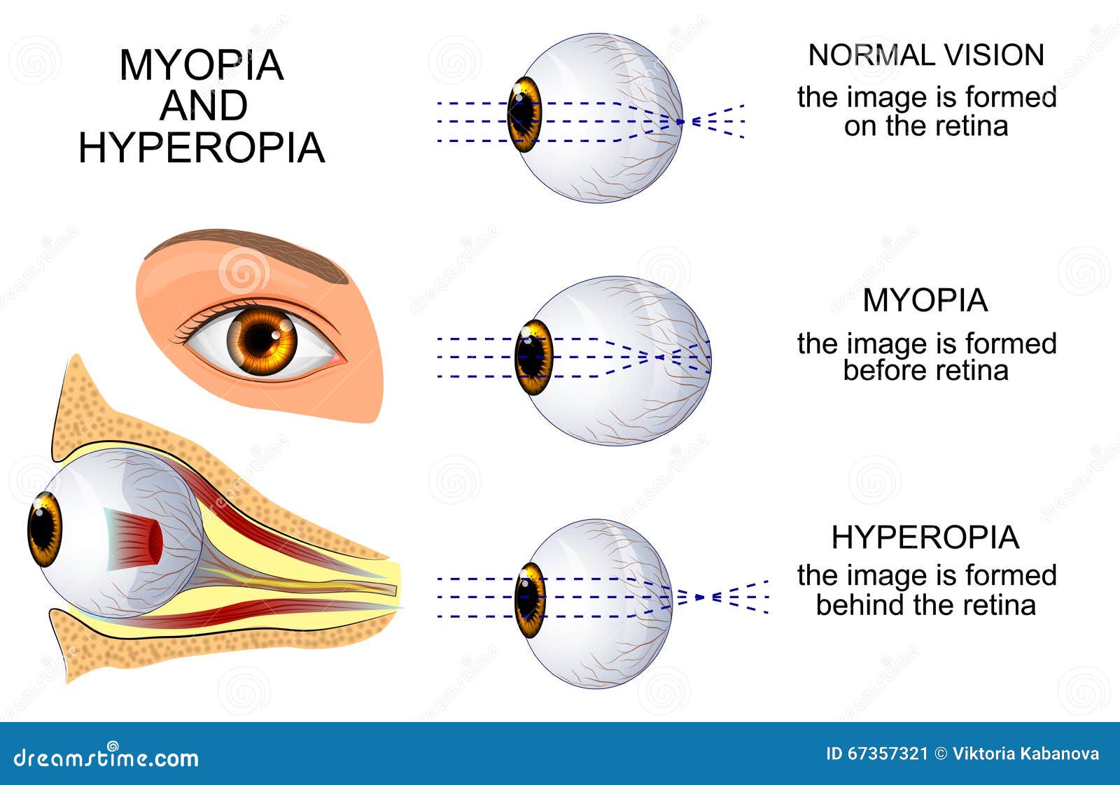 Myopi och Hyperopia vektor illustrationer. Illustration av ...