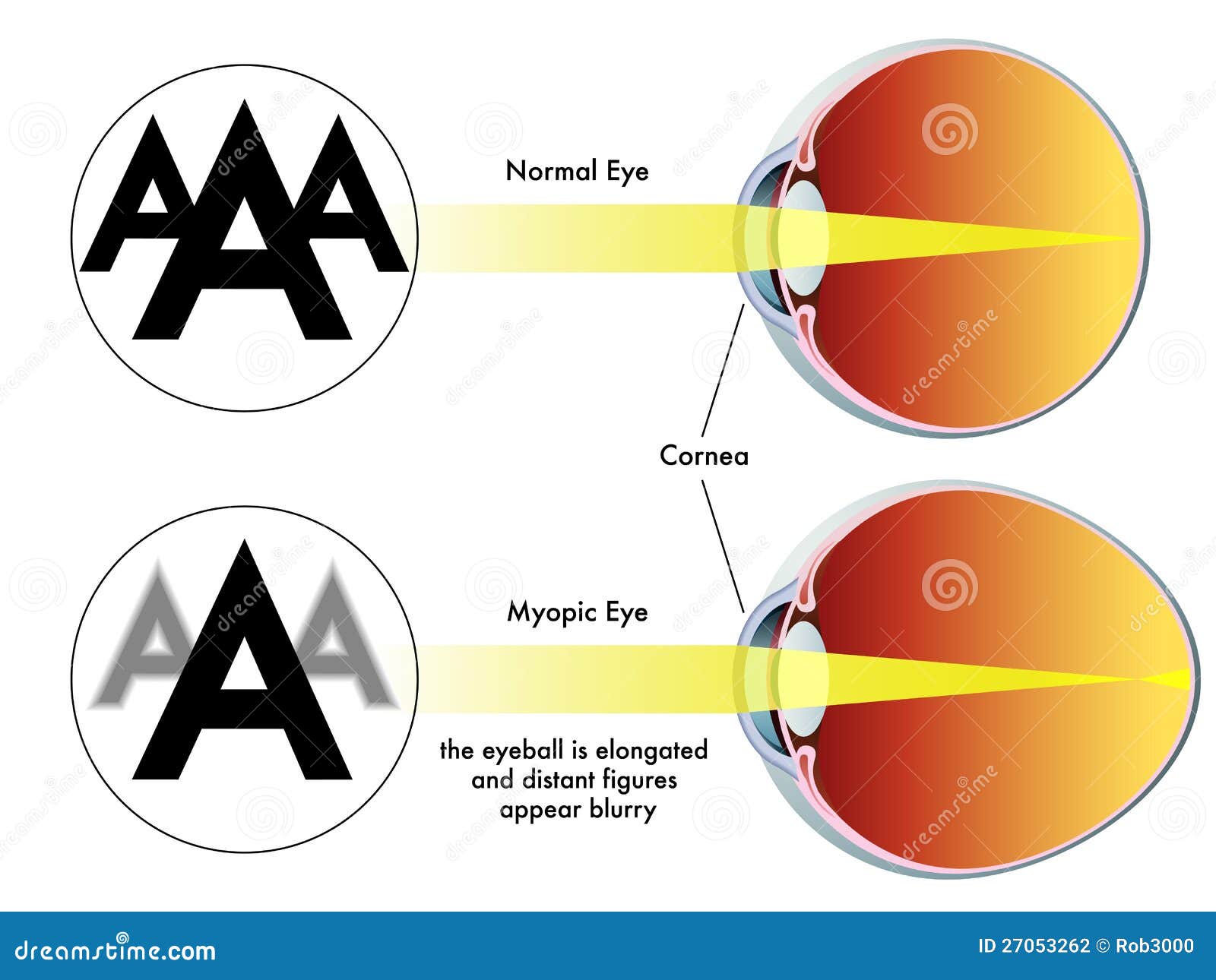 Myopia stock vector. Illustration of fatigue, topofrafia - 27053262