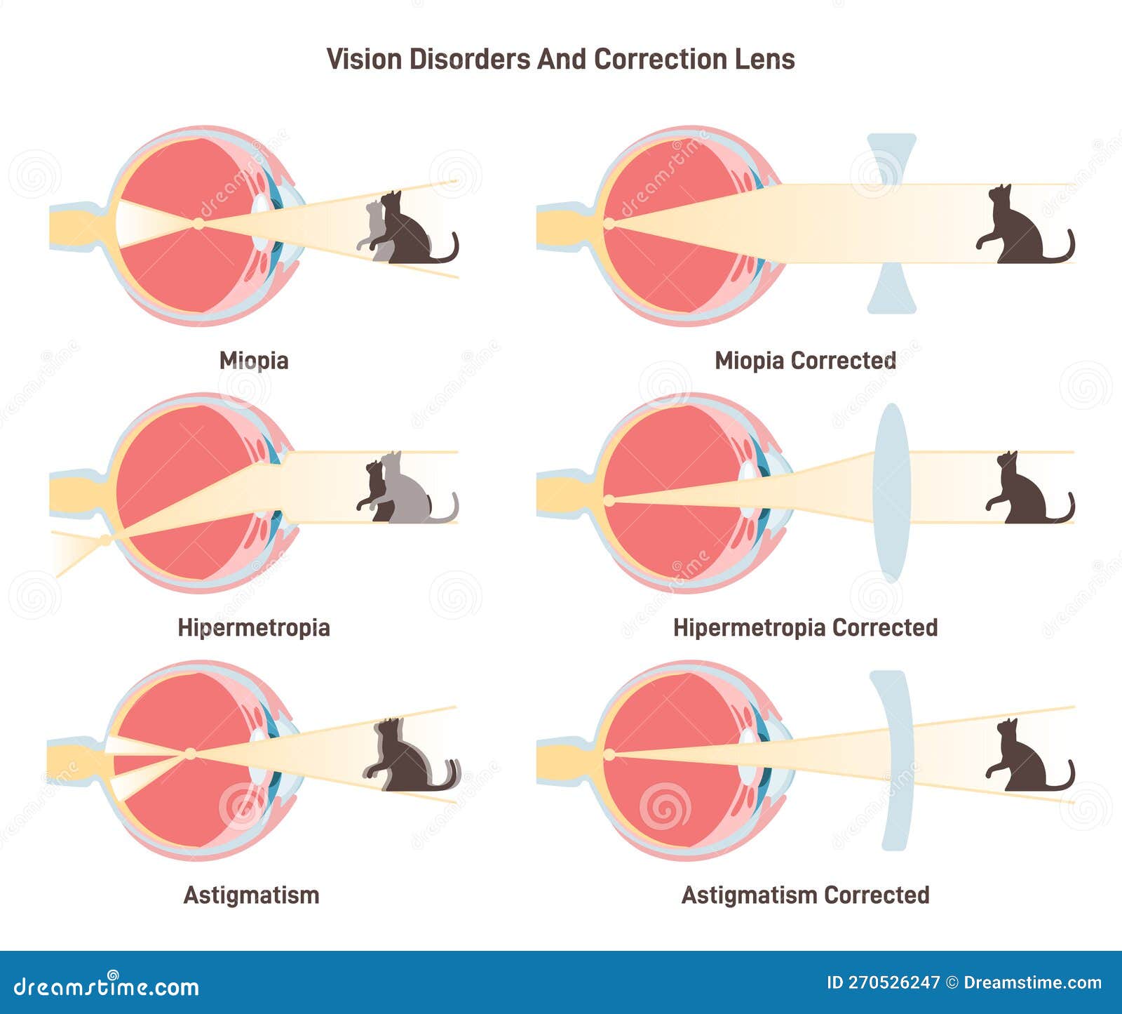 Myopia, Hyperopia and Astigmatism. Common Vision Disorders and Its ... Myopia, Hyperopia and Astigmatism. Common Vision Disorders and Its ...