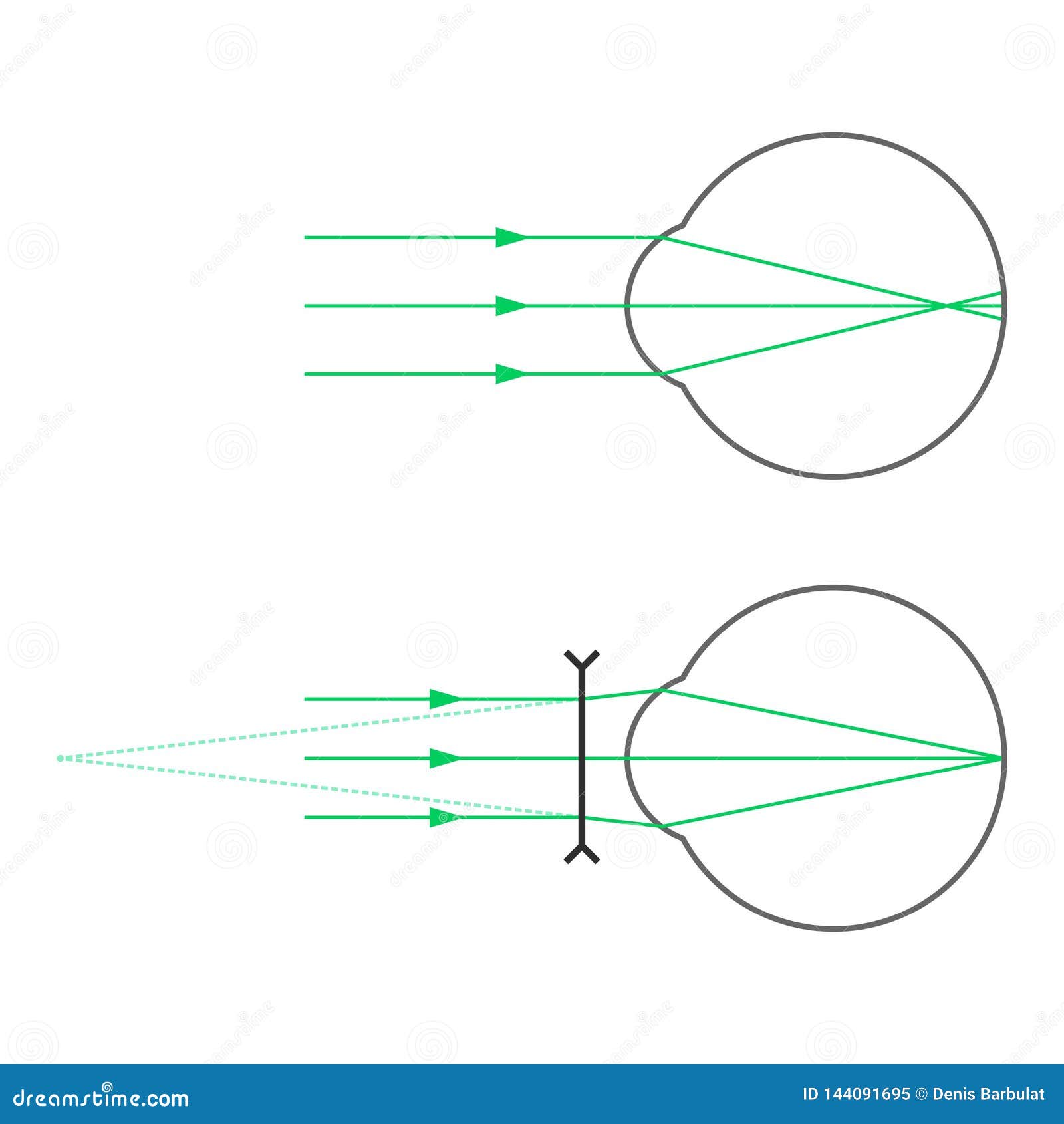 Myopia Nearsightedness and Myopia Correction with Glasses Stock Vector ...