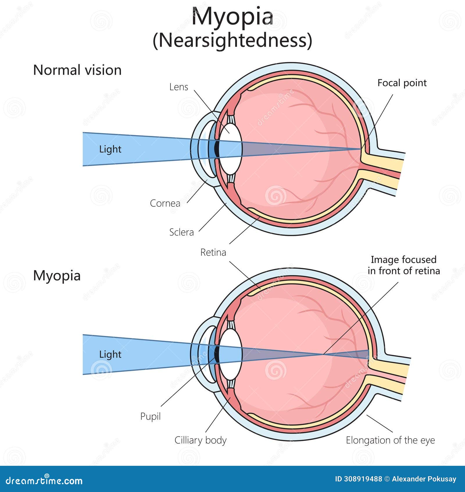 Myopia Structure Diagram Medical Science Stock Illustration ...