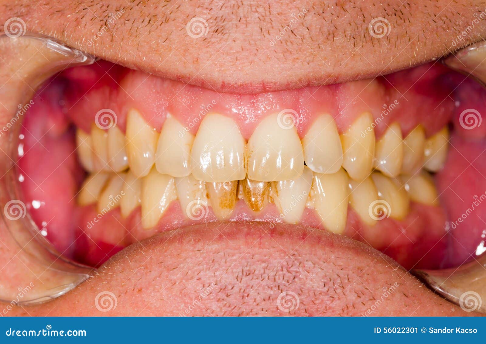 Nadelen van het Roken stock afbeelding. Image of tandarts - 56022301