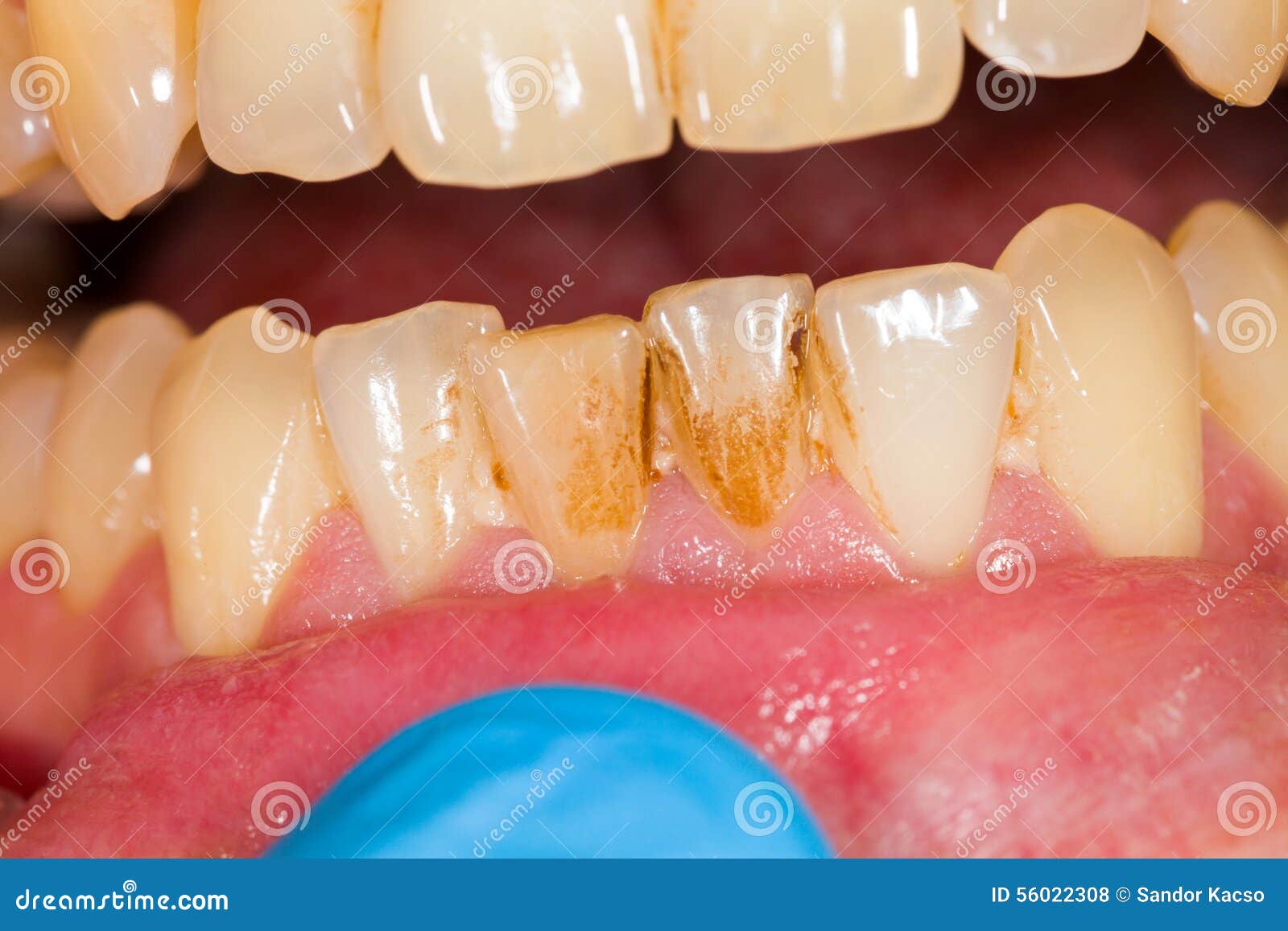 Nadelen van het Roken stock foto. Image of bureau, gezondheid - 56022308