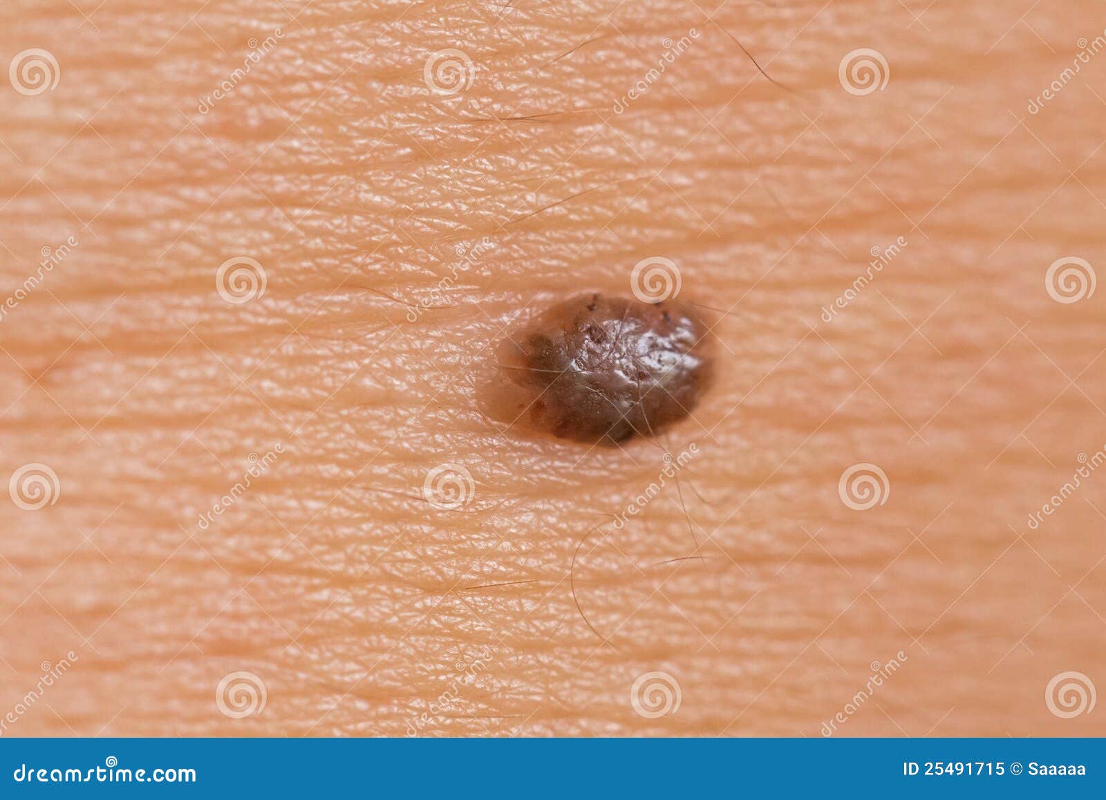 Naevus intradermique image stock. Image of fermer, naevus - 25491715