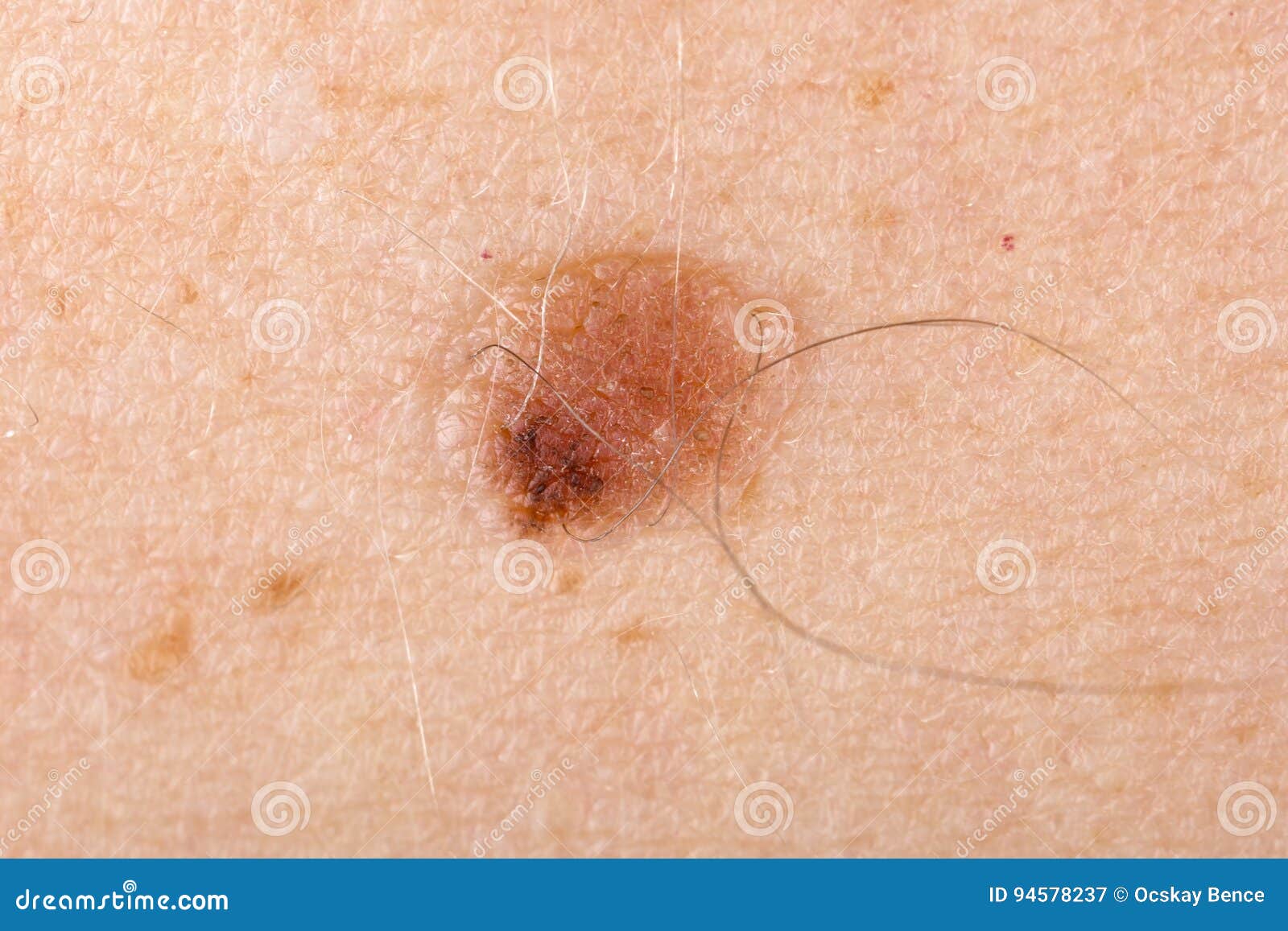 Naevus sur la peau humaine image stock. Image du dermatologie - 94578237