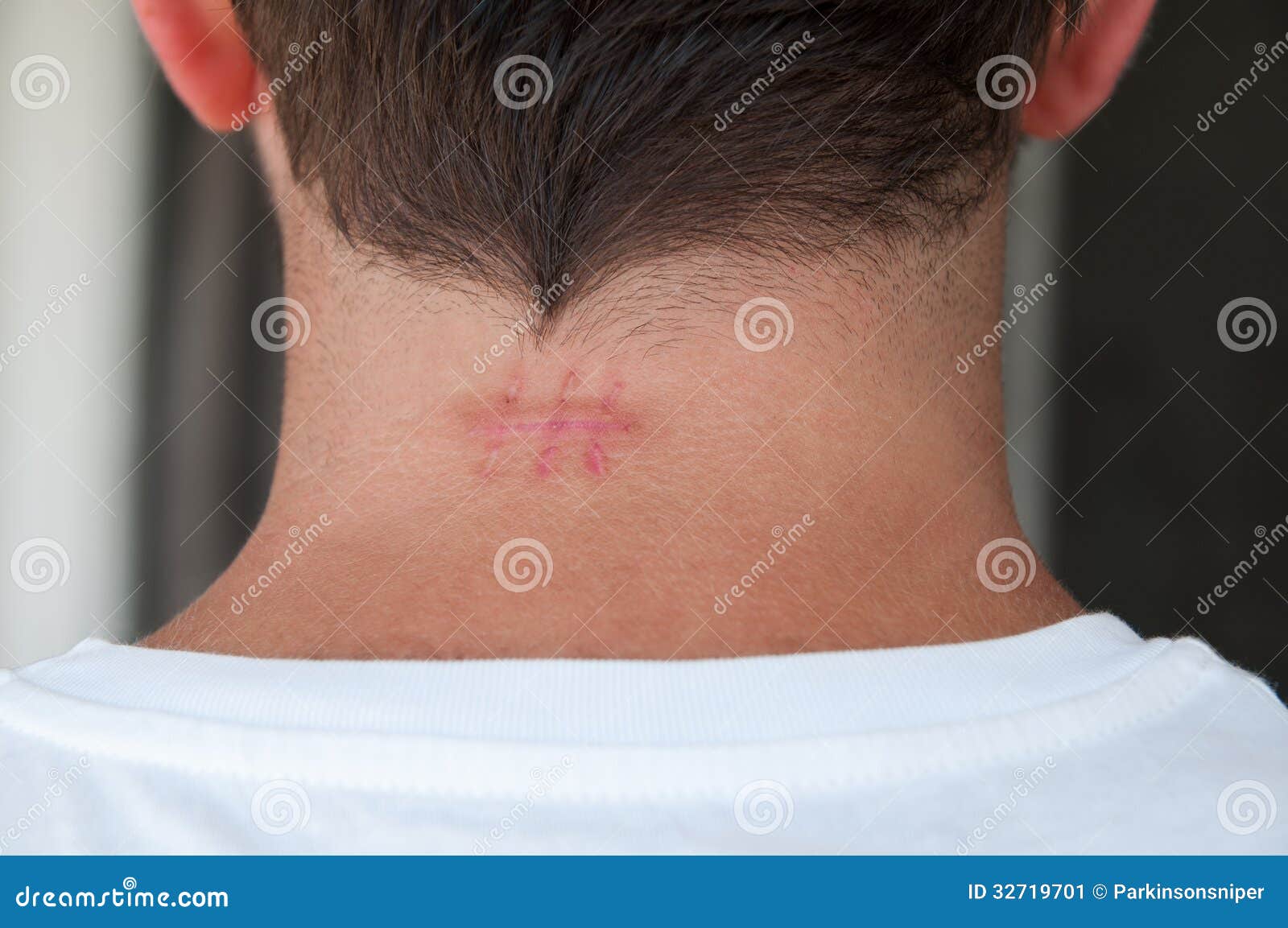 Naht-Narbe stockbild. Bild von mann, narkosen, narbe - 32719701