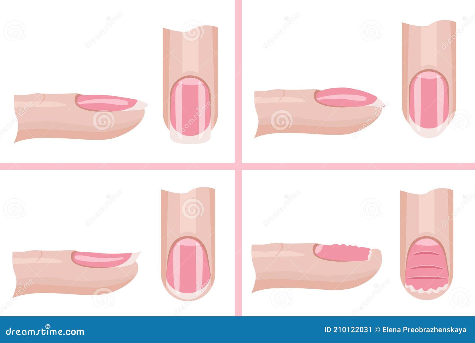 Nail Care. Types of the Nail Plate. Illustration for the Manicure Guide ...