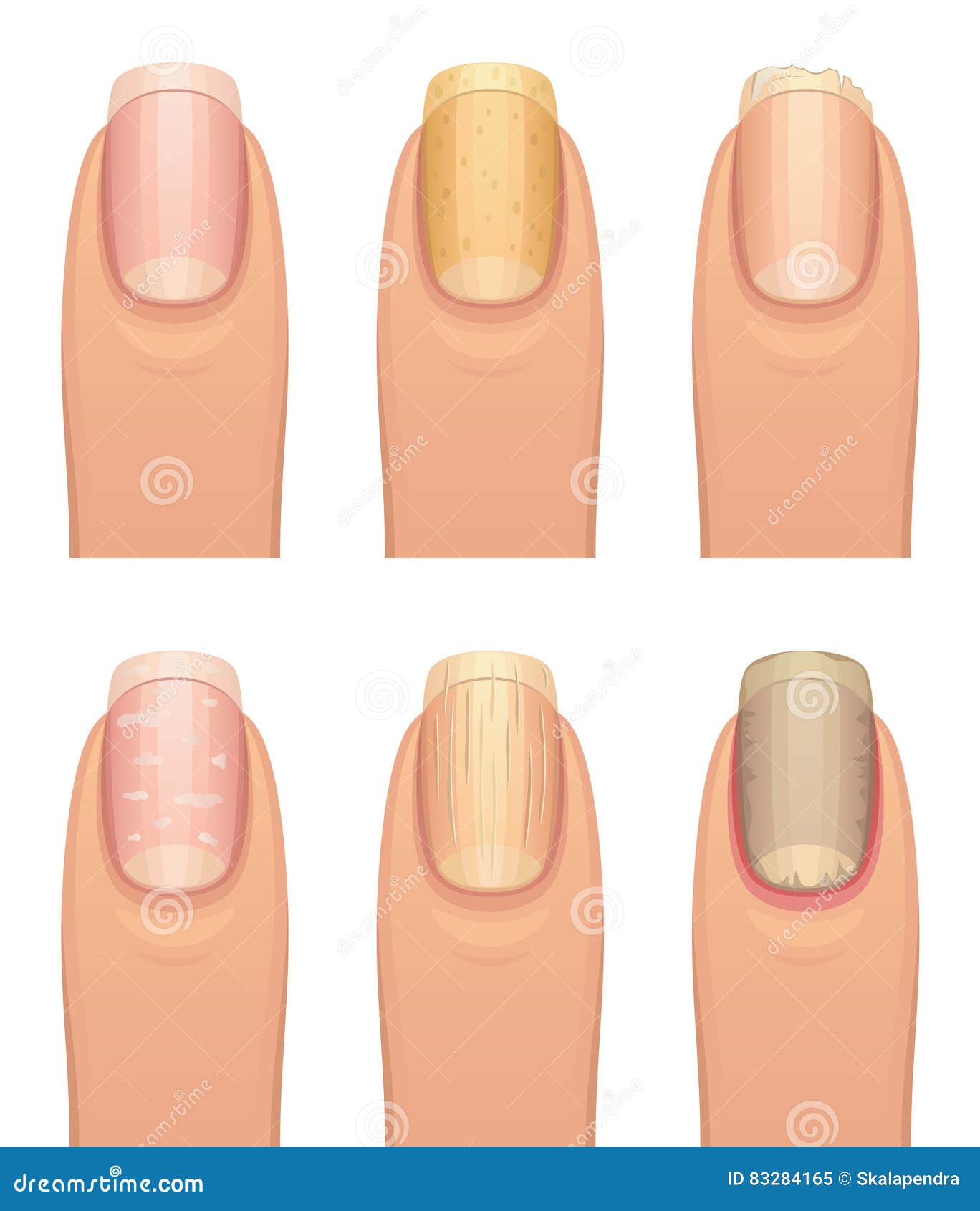 Nail Disease. Onychomycosis Concept. Fungal Nail Infection. Vector ...