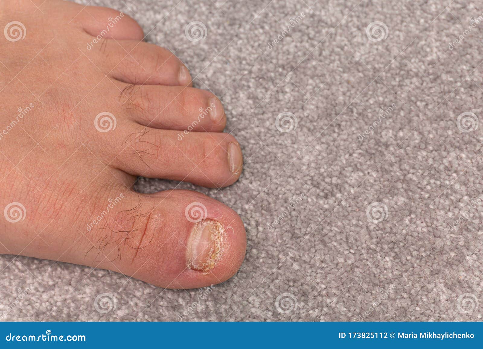 Nail Diseases on Left Mans Leg Stock Photo - Image of health, care ...