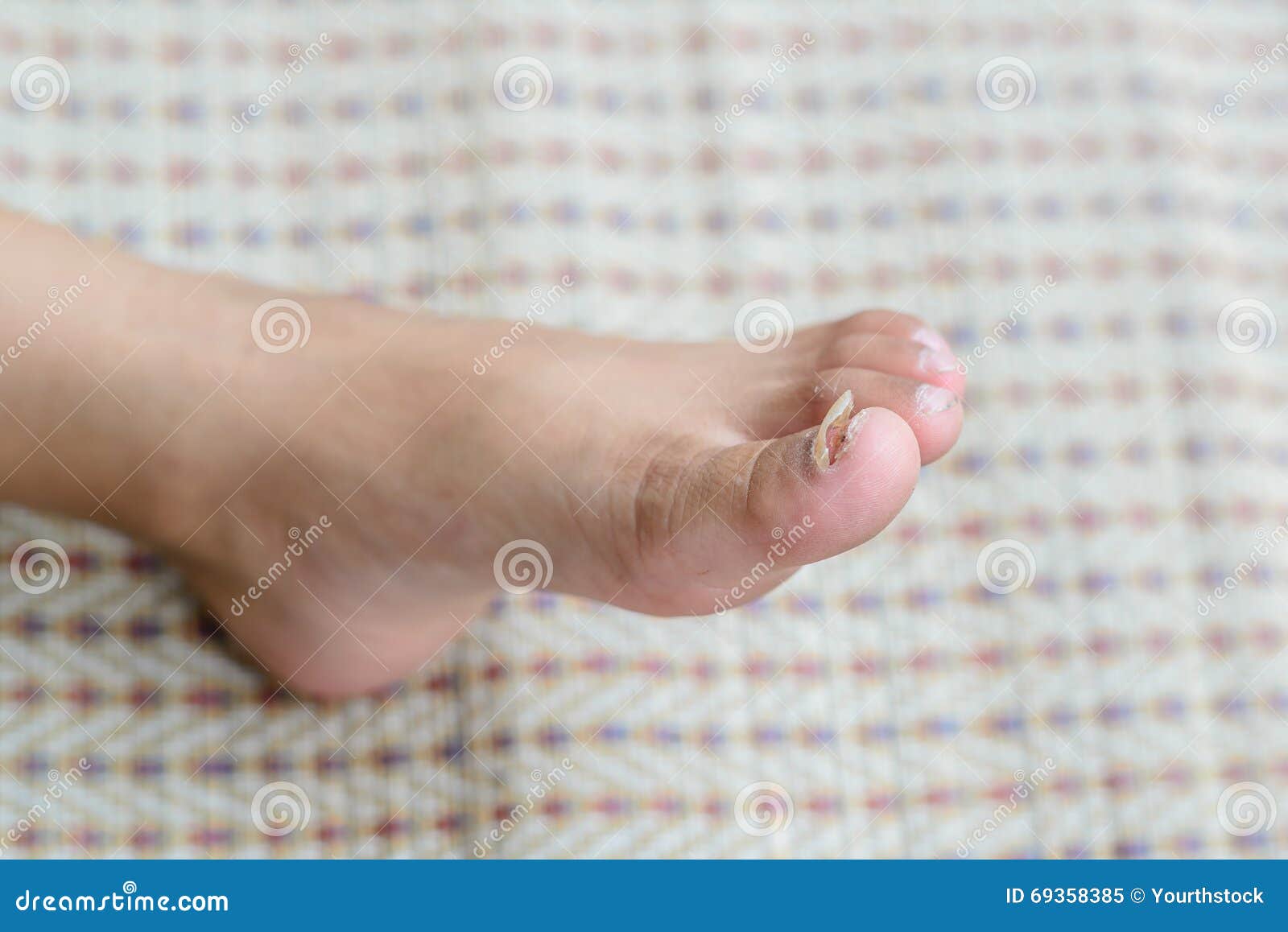 Nail extraction. stock image. Image of foot, barefoot - 69358385