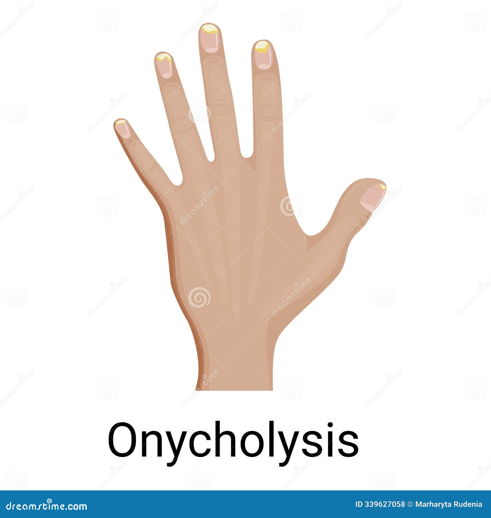 Nail Onycholysis Vector Illustration Design. Stock Illustration ...