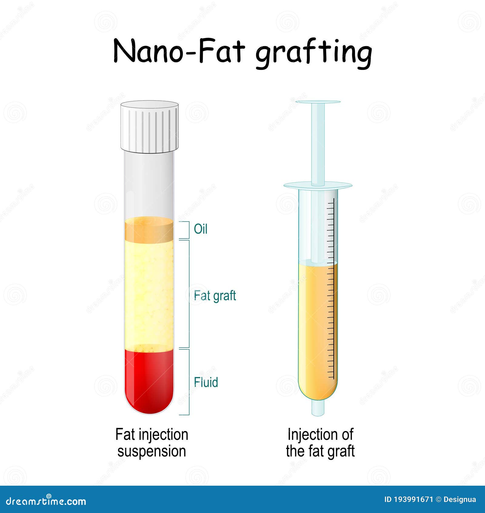 Nano-Fat Grafting. Test Tube with Fat Injection Suspension Stock Vector ... Nano-Fat Grafting. Test Tube with Fat Injection Suspension Stock Vector ...